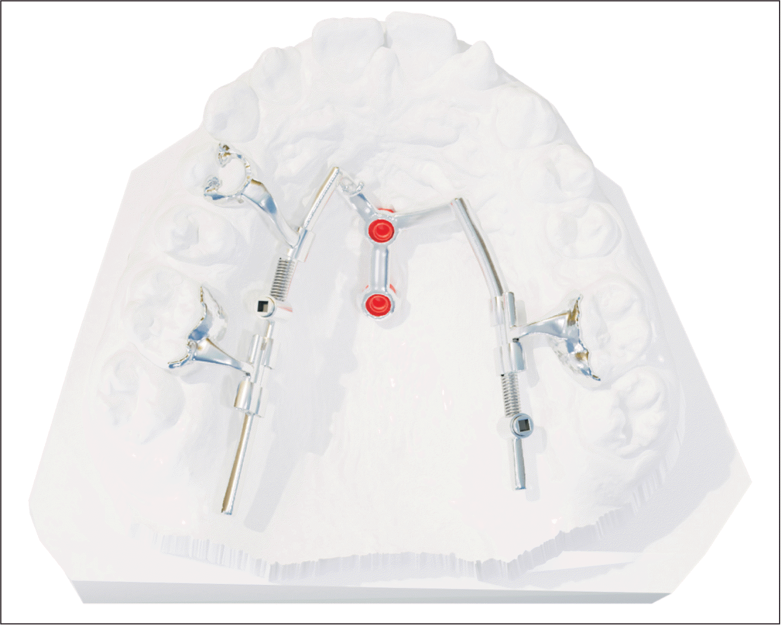 3D Printed Metal | Precision Orthodontic Devices by Cinchortho